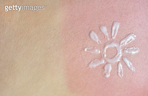 Sunburn and red skin on a female back with a painted sun from a ...
