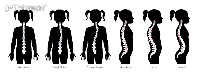 Girl spinal deformity flat vector illustration (1217056255) - 게티이미지뱅크