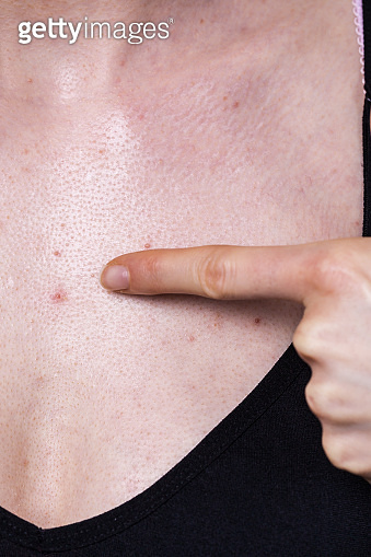 Woman having pimples red spots on chest (1291347188) - 게티이미지뱅크