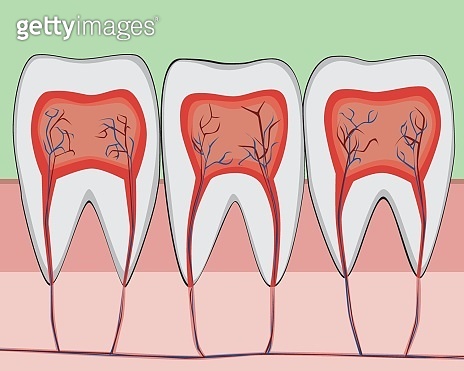A molar structure with enamel and nerves on the gum and jaw,a flat ...