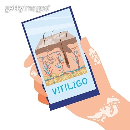 Smartphone and hand with vitiligo and anatomical structure of skin ...