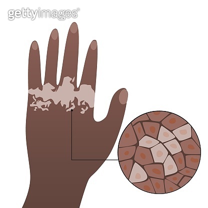 African hand with vitiligo and the anatomical structure of skin cells ...