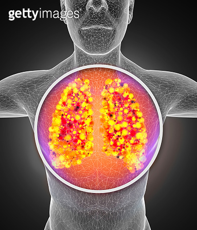 Human anatomy, problems with the respiratory system, severely damaged ...