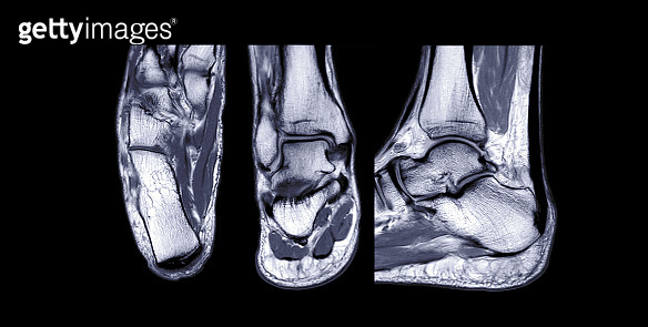 Compare MRI Ankle joint axial , coronal and Sagittal t2 view for ...