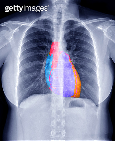 Fusion image of Chest X-ray image and 3D CTA Coronary artery Image ...