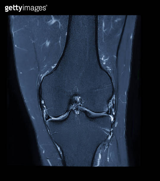 MRI knee or Magnetic resonance imaging of knee joint stir technique of ...