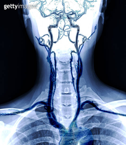 X-ray C-spine or x-ray image of Cervical spine AP view with cta carotid ...