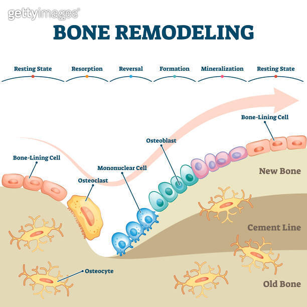 Bone remodeling process educational explanation with labeled structure ...