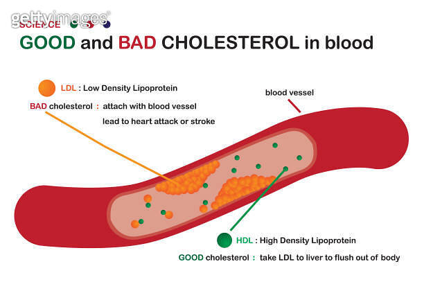 Science diagram show good and bad cholesterol (LDL and HDL) in blood ...
