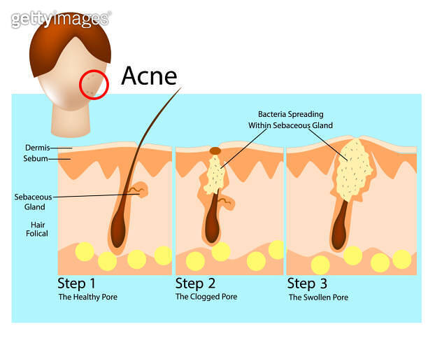 How acne develops. Acne stages. Formation of skin acne or pimple ...