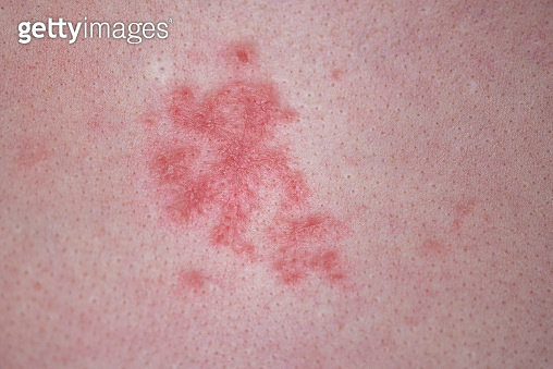 Human skin with red allergic spots, sores 이미지 (1280473035) - 게티이미지뱅크