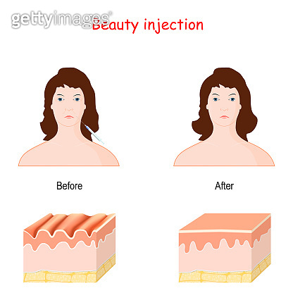 beauty injection. dermal filler. 이미지 (1197848998) - 게티이미지뱅크