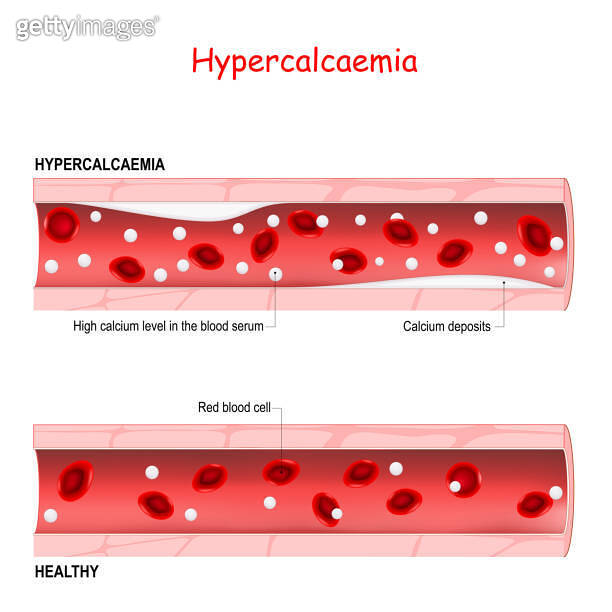 Hypercalcaemia. hypercalcemia is a high calcium level in the blood ...
