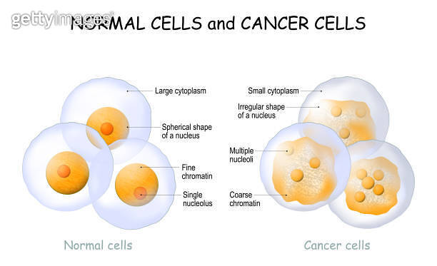 Cancer cells and Normal cells. comparison and difference (1287659732 ...
