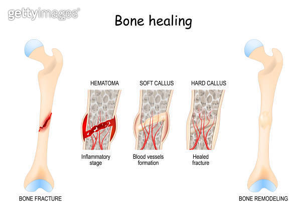 Bone healing Process after a bone fracture (1255792751) 일러스트, 무료 일러스트 ...