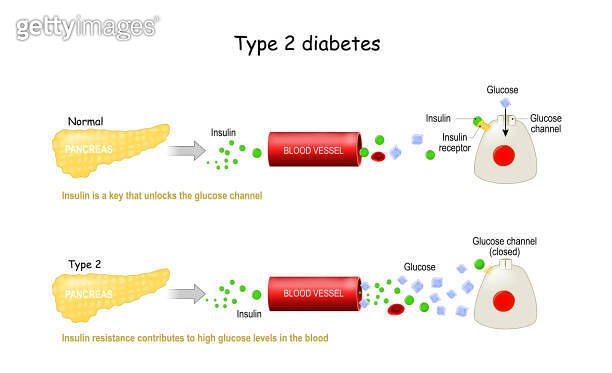 Types 2 of Diabetes Mellitus. Comparison of cell work in diabetes and ...