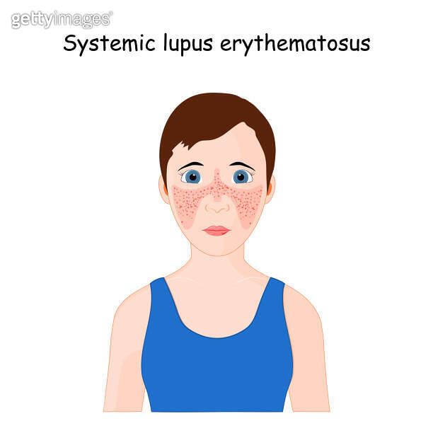Young woman with the typical butterfly rash in lupus 이미지 (1255079429 ...