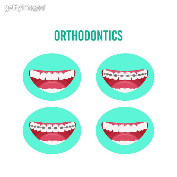 Orthodontic treatment with dental braces, stages of the teeth alignment ...