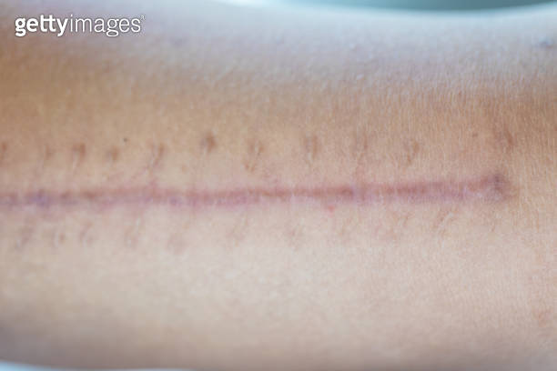 A scar is an area of fibrous tissue that replaces normal skin after an ...