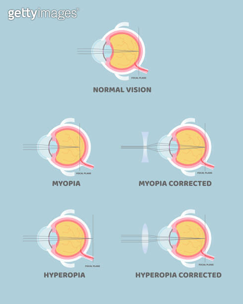 eyeball anatomy, internal organs body part nervous system, shortsighted ...