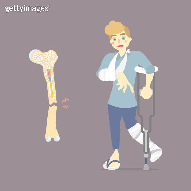 sad patient with cast on broken leg and arm bone holding crutch ...