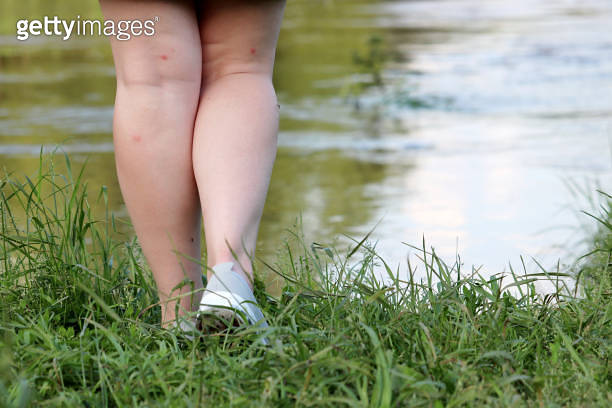 Female legs bitten by mosquitoes on a river coast 이미지 (1249000504) - 게티 ...