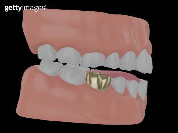 human jaw with gold tooth, golden crown of a molar, 3d render ...