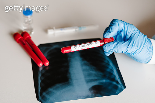 A doctor hand hold a test tube with biological sample blood on ...
