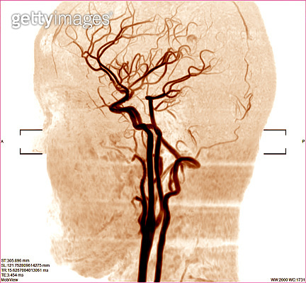 MRI of the blood vessels 이미지 (1207432838) - 게티이미지뱅크