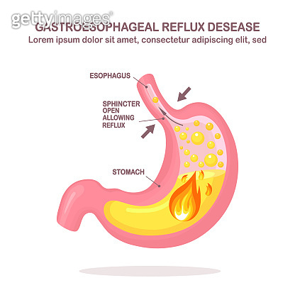 Human stomach. Gastroesophageal reflux disease. GERD, heartburn ...
