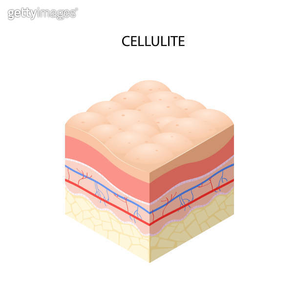 skin with cellulite cross-section of human skin layers structure ...
