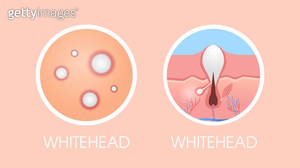 skin whitehead pimples acne type face pore comedones cosmetology ...