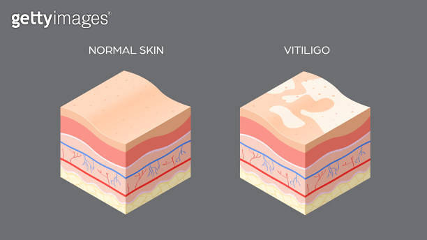 vitiligo and normal skin cross-section of human skin layers structure ...