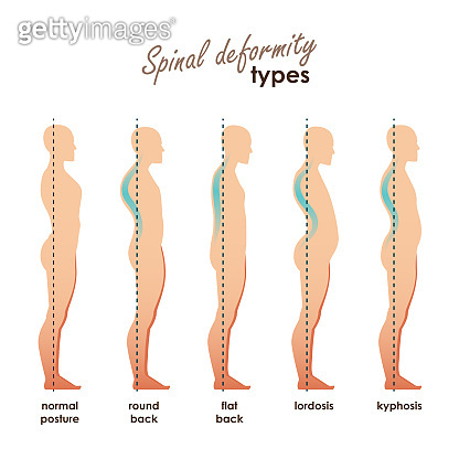 Spinal deformity types. Diseases of the spine.Lordosis, kyphosis, round ...