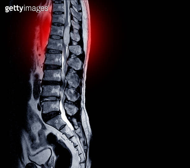 MRI scan of lumbar spines of a patient finding Spinal mass at Lt.side ...