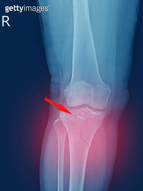 X-ray knee Fracture proximal metaphysis of tibia.Depressed fracture of ...
