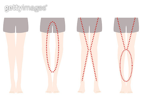 Comparison and distortion of O-legs and X-legs 이미지 (1288596454) - 게티이미지뱅크