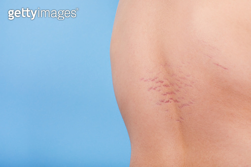 Close up view of the back with striae distensae (striae rubrae) on the ...
