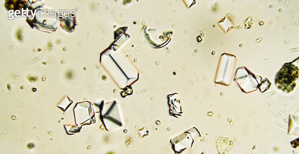 Struvite crystals in pet Urine under a microscope (1311131012) - 게티이미지뱅크