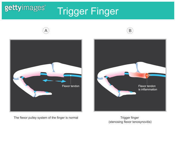Trigger finger. illustration explain a symptom of locked finger caused ...