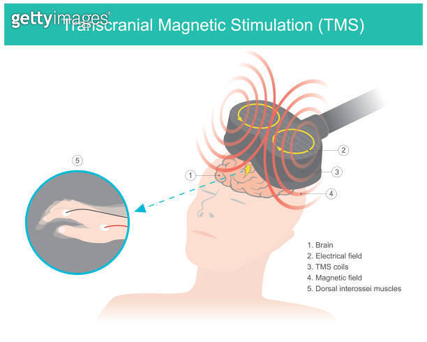 Transcranial Magnetic Stimulation (TMS). (1308128837) - 게티이미지뱅크