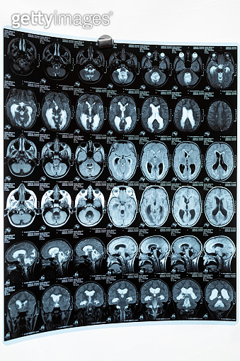 MRI scan or magnetic resonance image of the brain showed obstructive ...