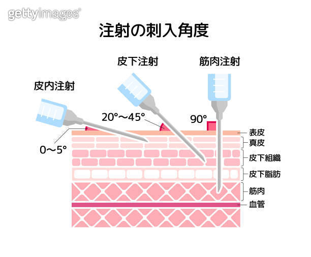 Angles for Inserting Injections vector illustration (1322277209) - 게티이미지뱅크