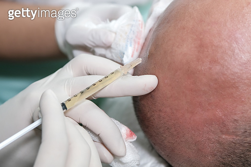 Balding man getting hair mesotherapy or scalp prp: Platelet-rich plasma ...