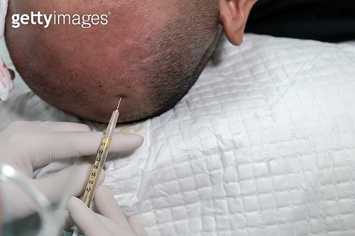 Balding man getting hair mesotherapy or scalp prp: Platelet-rich plasma ...