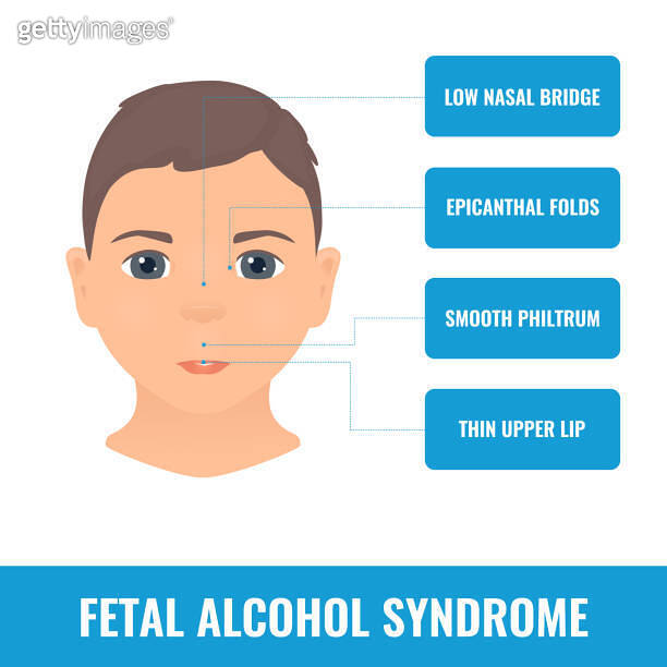 Fetal alcohol syndrome facial features in a child (1347275408) 일러스트, 무료 ...