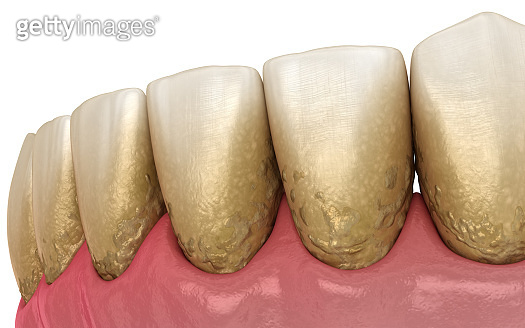 Tartar and bactrail tooth plaque, lower jaw. Medically accurate 3D ...