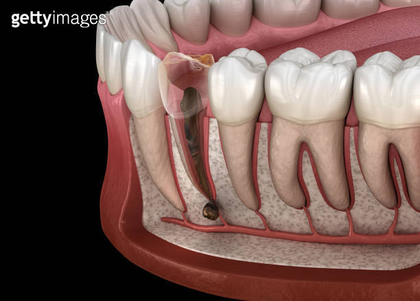 Periostitis tooth - Lump on Gum Above Tooth. Medically accurate dental ...