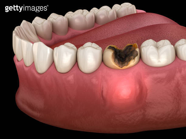 Periostitis tooth - Lump on Gum Above Tooth. Medically accurate dental ...