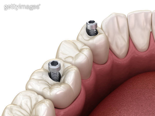 Premolar and Molar tooth crown installation over implant, screw ...